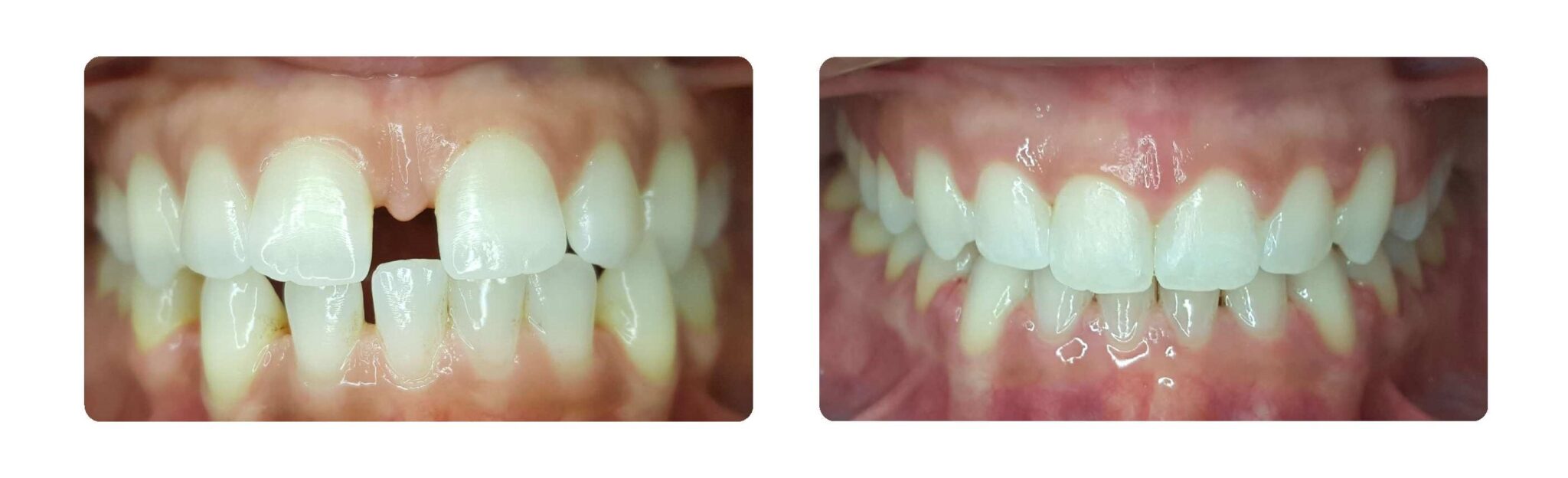 Before & After - All Smiles Orthodontics